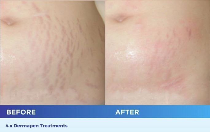 Dermapen Collagen Induction Therapy - Mabin House
