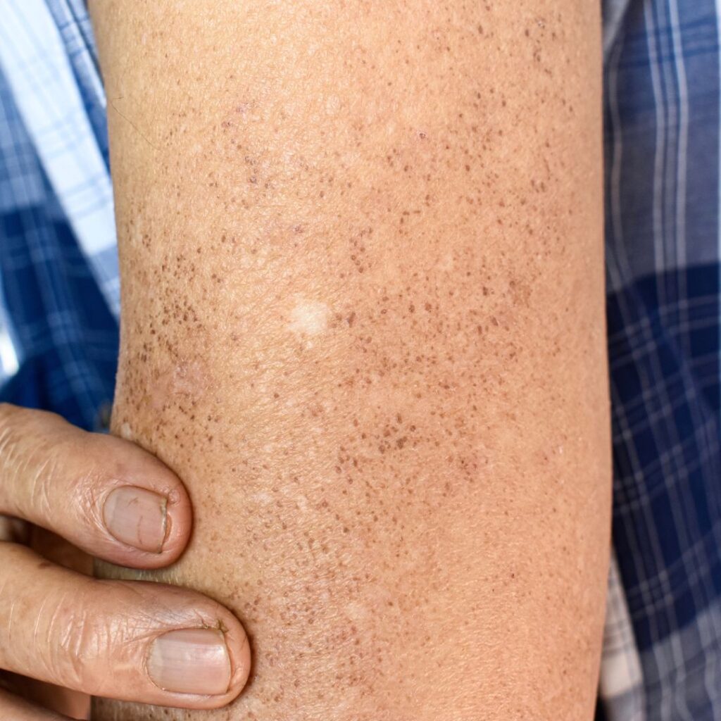 Skin Pigmentation Treatment at Mabin House